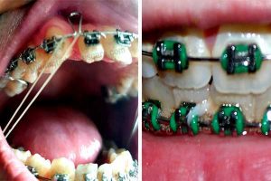 Loose Braces Bracket: Causes, What To Do - Orthodontic Braces Care