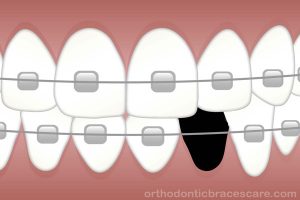 Flared Teeth After Braces: Reasons, How To Fix - Orthodontic Braces Care