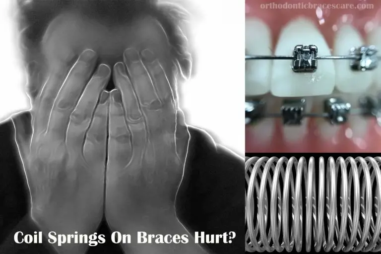 Coil Springs Braces Hurt: How long, Causes, Pain Relief Tips ...
