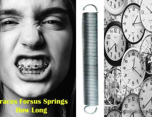 Broken Braces Coil Spring: How To Fix, Why This Happens | Orthodontic ...