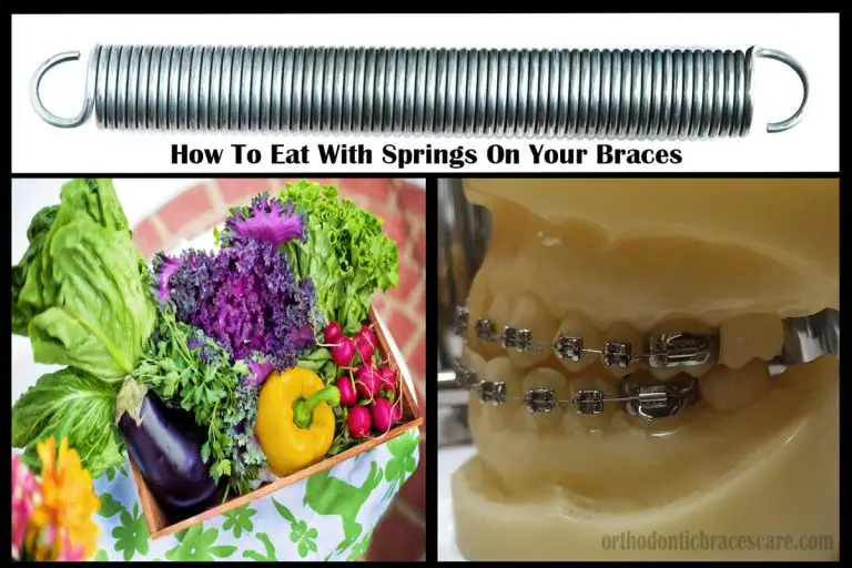 How To Eat With Springs On Your Braces - Orthodontic Braces Care