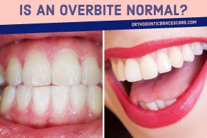Is An Overbite Normal? How To Diagnose It? - Orthodontic Braces Care