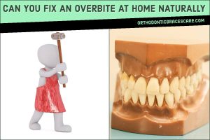 Can You Fix An Overbite At Home Naturally - Orthodontic Braces Care
