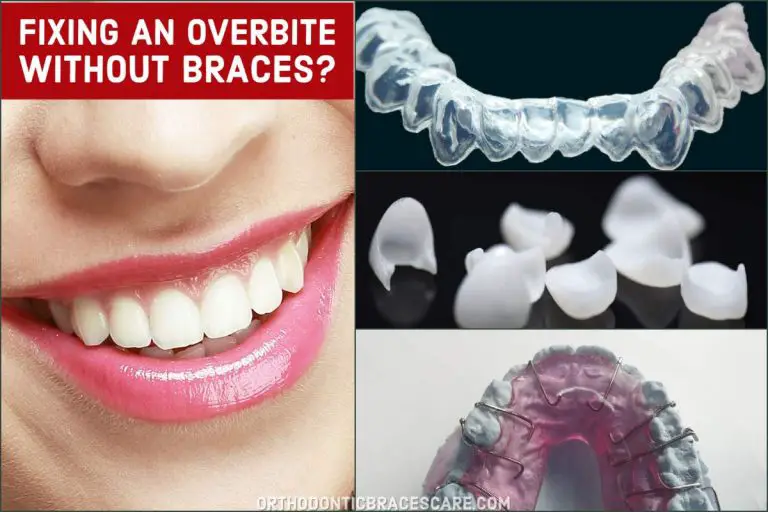 How To Fix An Overbite Without Braces - Orthodontic Braces Care