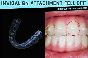 Invisalign Not Tracking One/Whole Tooth: Causes, Fixes - Orthodontic ...