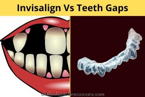 Can Invisalign Close Teeth Gaps [How long it takes] - Orthodontic ...
